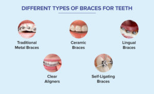 What are Teeth Braces Costs, Types and Benefits? - Radiant Dental