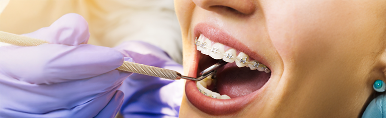 How To Take Care of Braces - Precautions and Tips