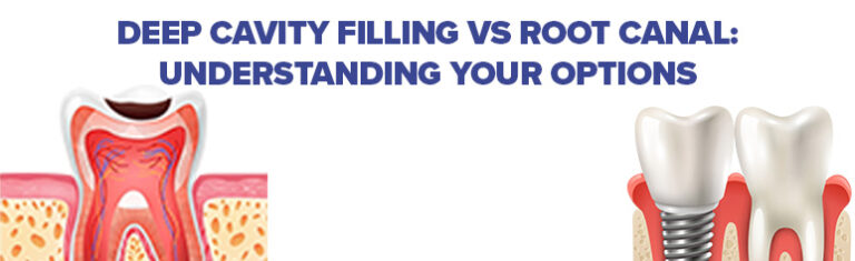 Deep Cavity Filling vs Root Canal: Understanding Your Options