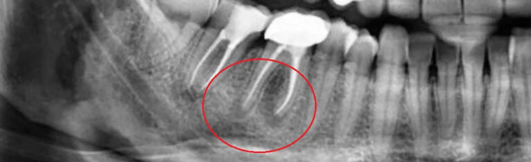 Dental Granuloma: Symptoms, Causes and Treatment Explained by Experts