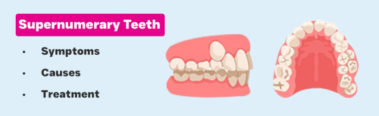 Supernumerary Teeth: Symptoms, Causes and Effective Treatment | Best ...